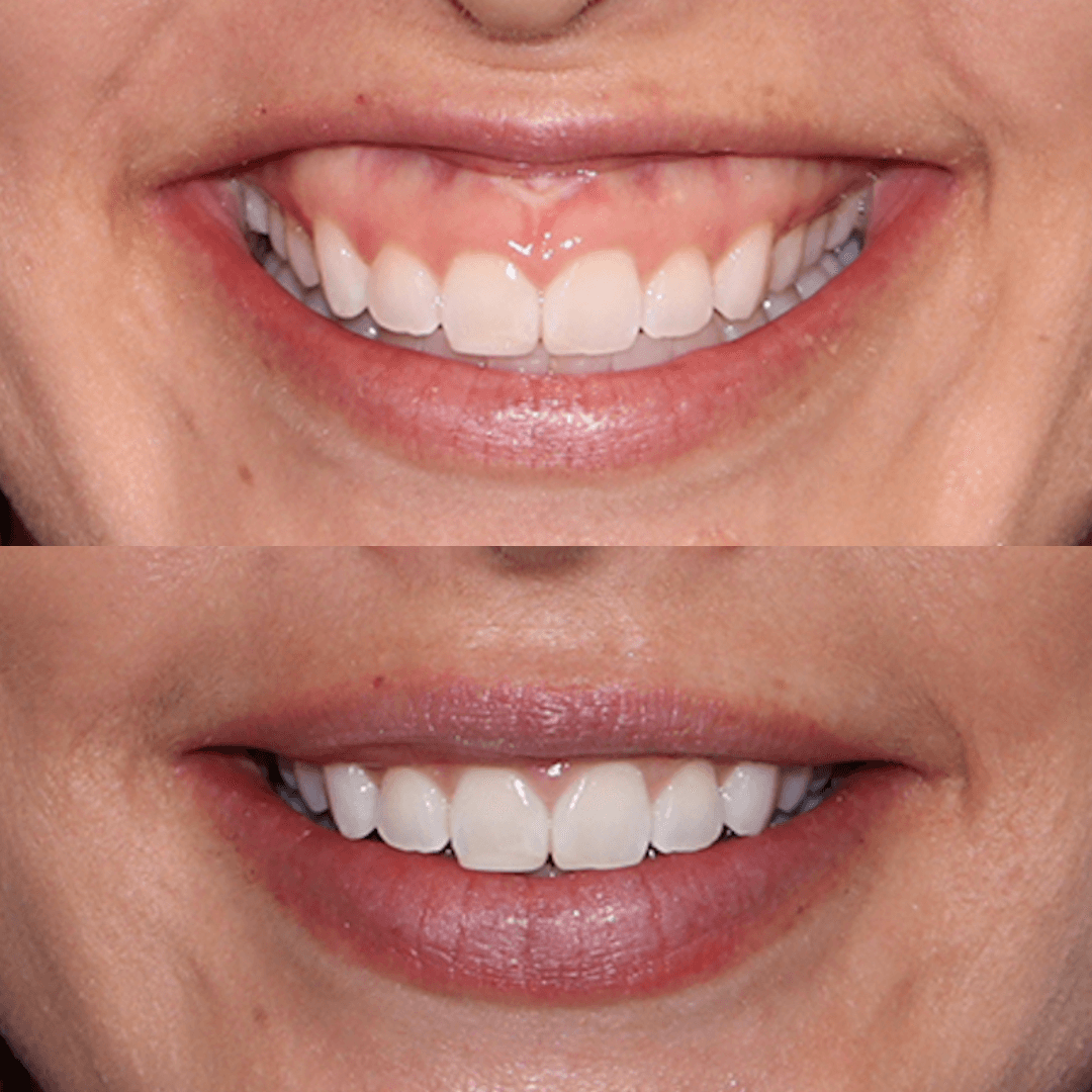 Botox® - Health & Co